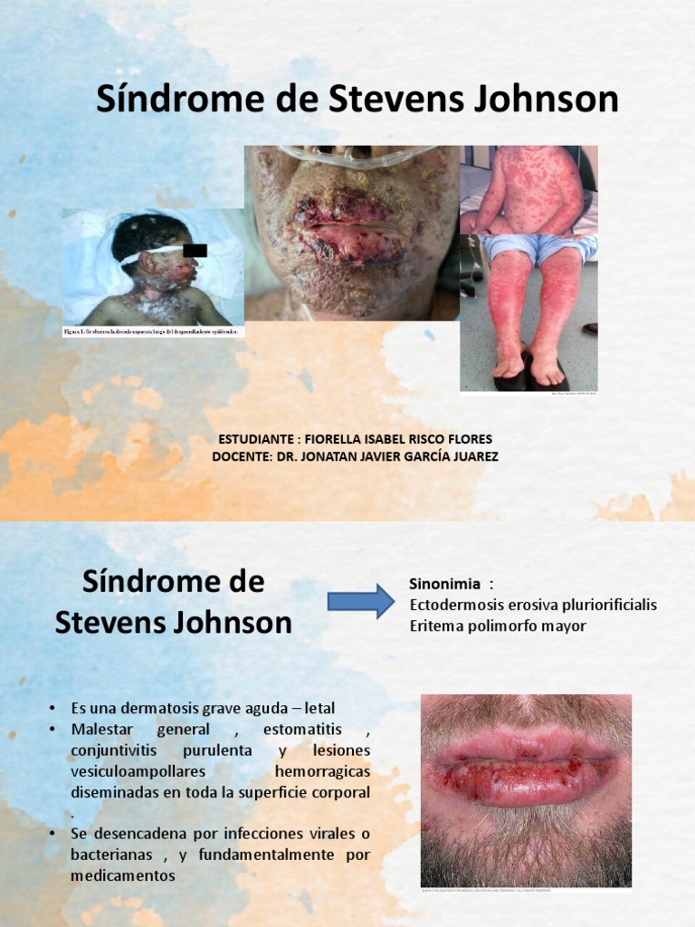 Síndrome de Stevens Johnson | PDF | Medicina CLINICA | Enfermedades y ... Síndrome de Stevens Johnson | PDF | Medicina CLINICA | Enfermedades y ...