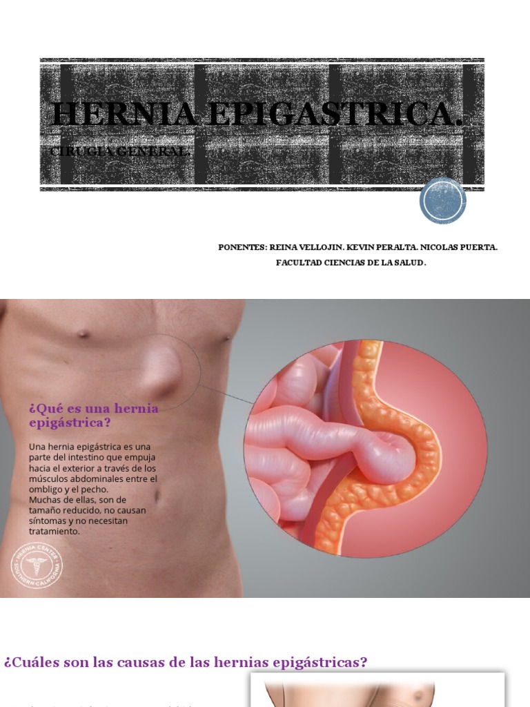 CX General - Hernia Epigastrica. Reina - Kevin - Nicolas. | PDF