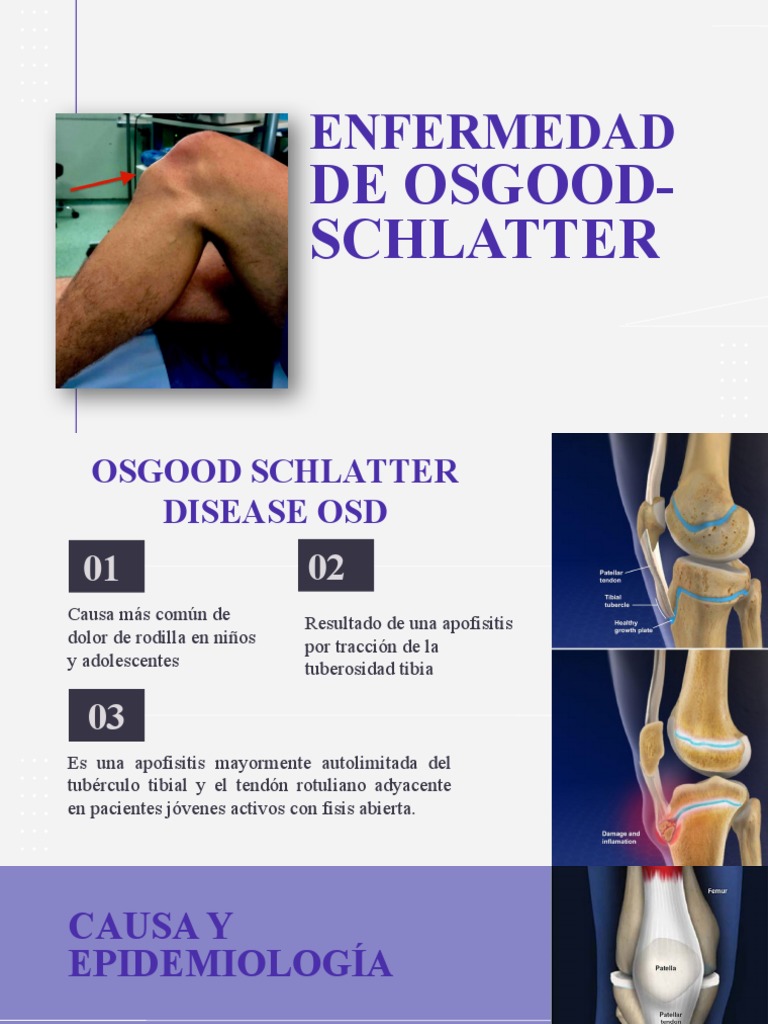 Enfermedad Osgood-Schlatter | PDF | Rodilla | Medicina CLINICA