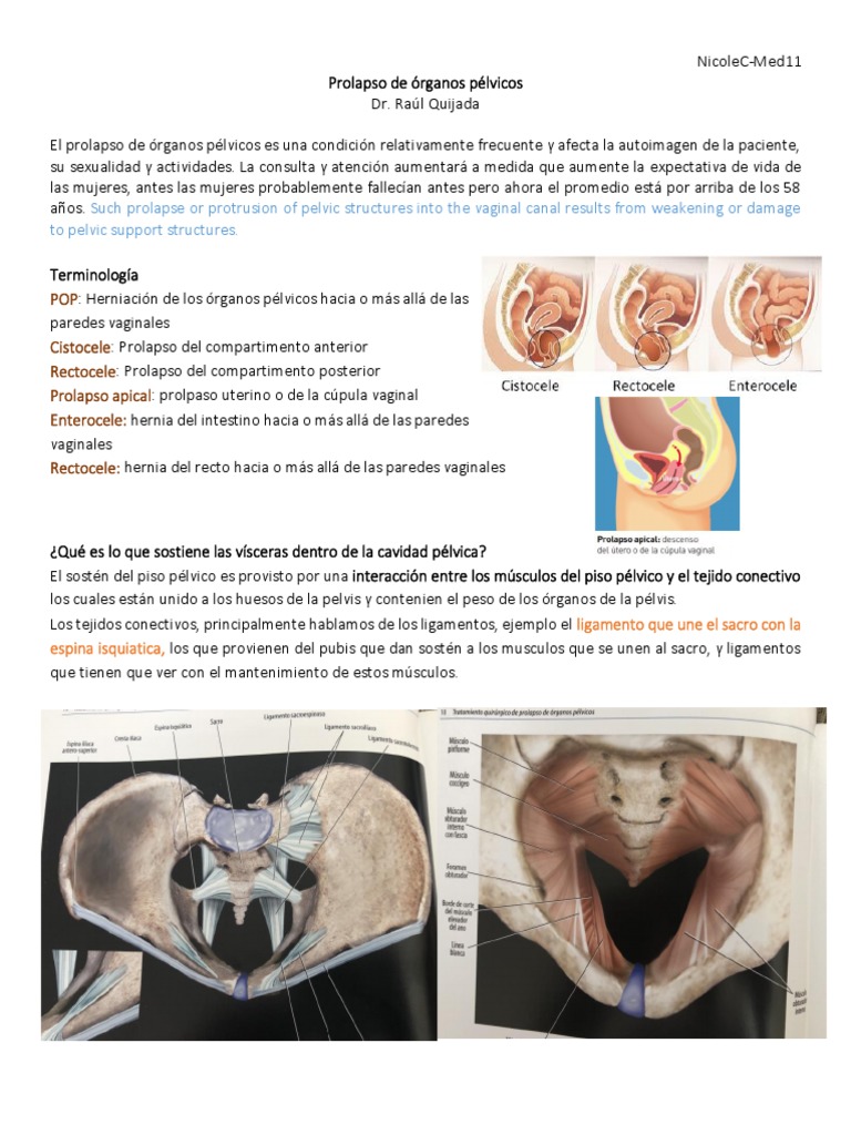 Prolapso de Órganos Pélvicos: Guía Completa | PDF | Vejiga urinaria ...