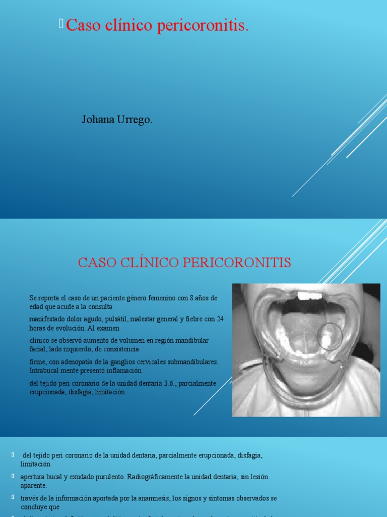 Caso clínico de pericoronitis en niña | PDF