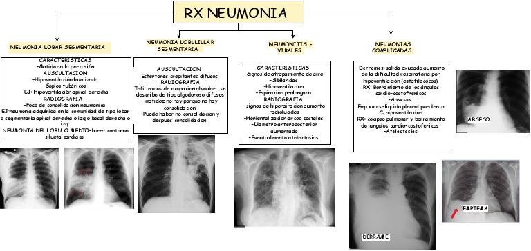 RX Neumonia | PDF | Neumonía | Enfermedades y trastornos