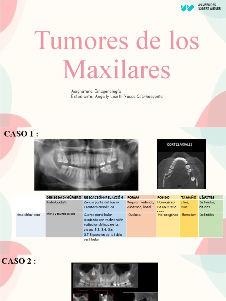 Tumores de Los Maxilares | PDF