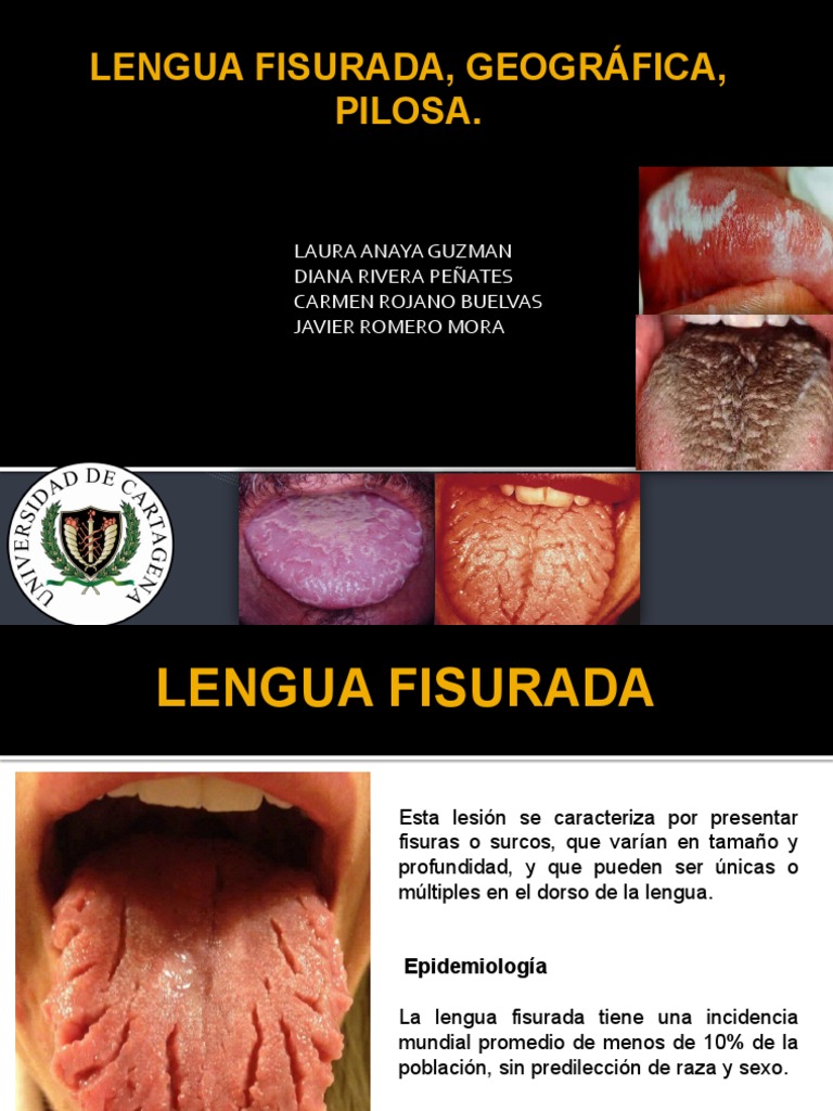 4.seminario, Lengua Fisurada | PDF | Medicina | Enfermedades y trastornos