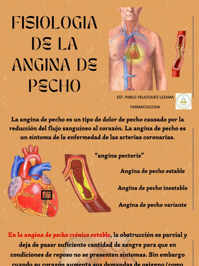 Angina de Pecho | PDF