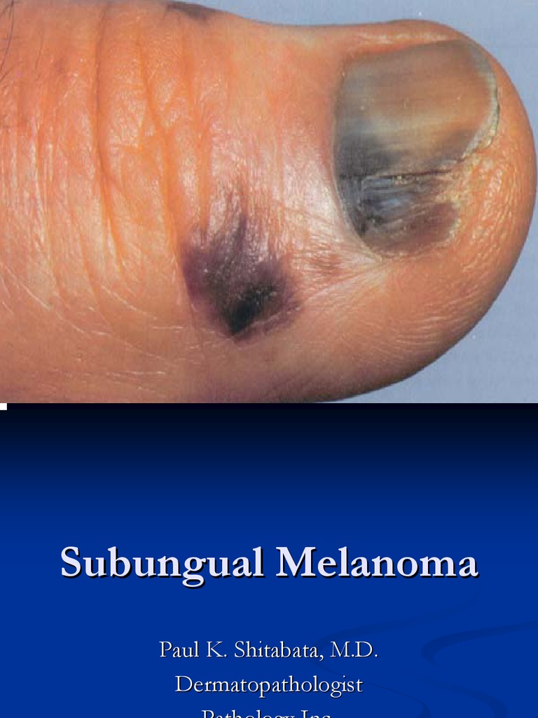 Subungual Melanoma