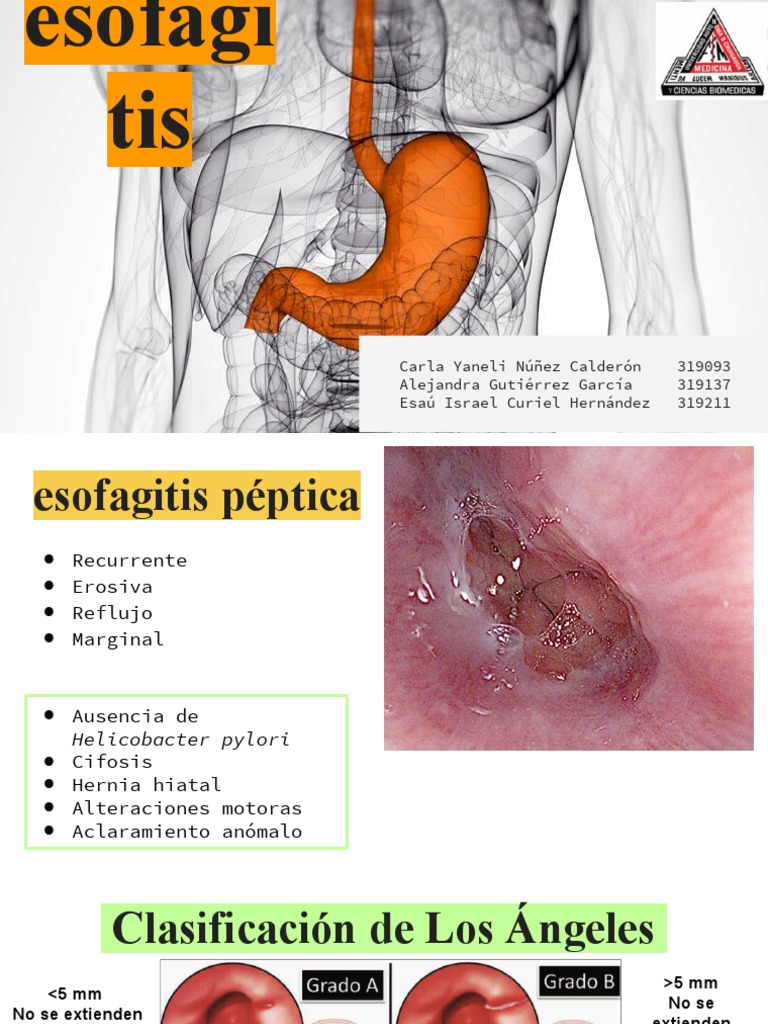 Esofagitis | PDF