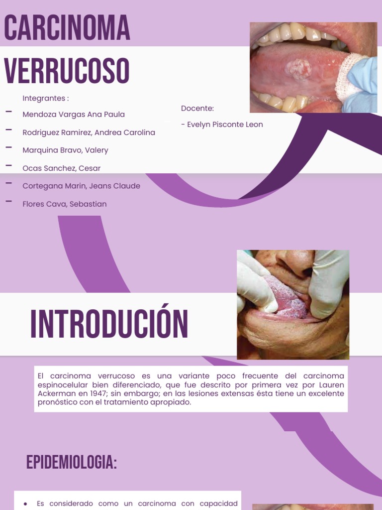 Carcinoma Verrucoso | PDF | Cáncer | Odontología