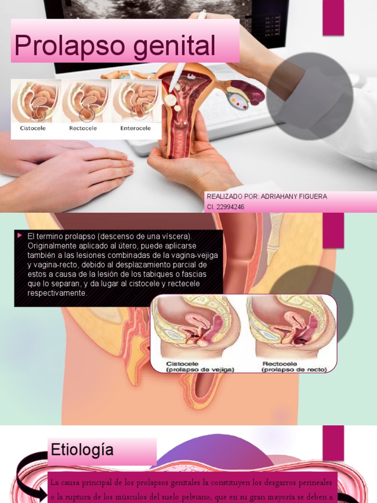 Prolapso Genital ADRI | PDF | Vejiga urinaria | Vagina
