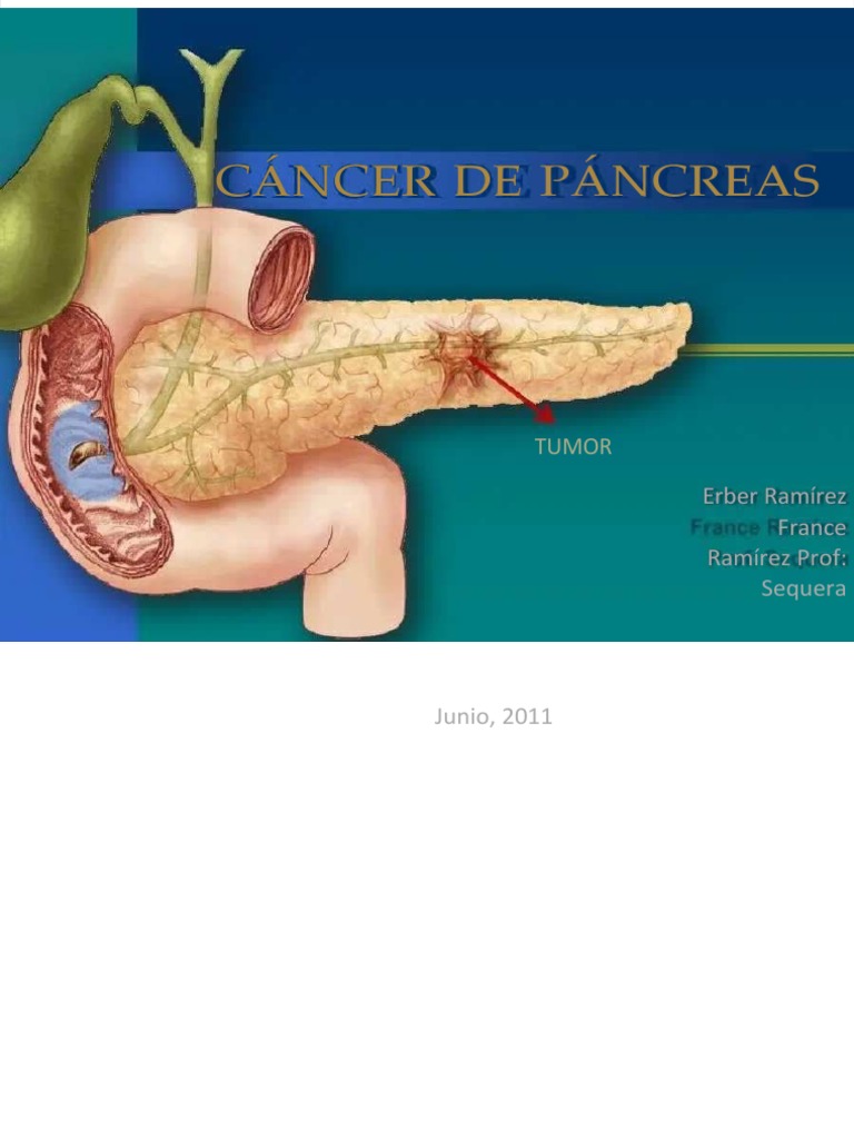 PDF Cancer de Pancreas | PDF | Cocina, comidas y vino