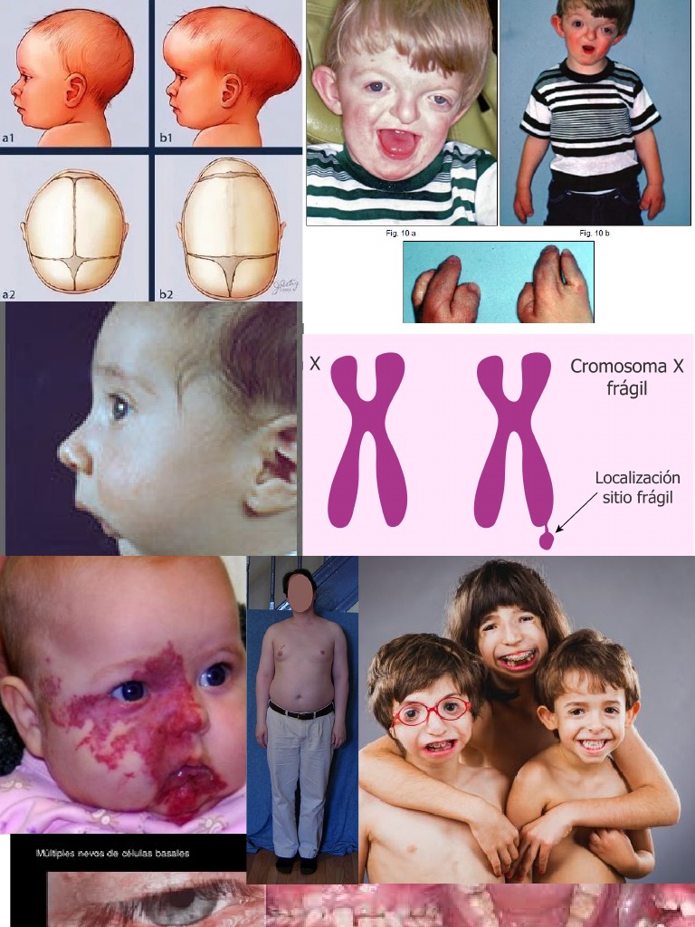 Collage de Sindromes | PDF