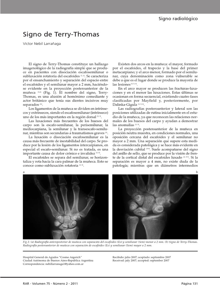 MuÃ Eca Signo de Terry Thomas | PDF | Sistema musculoesquelético | Medicina