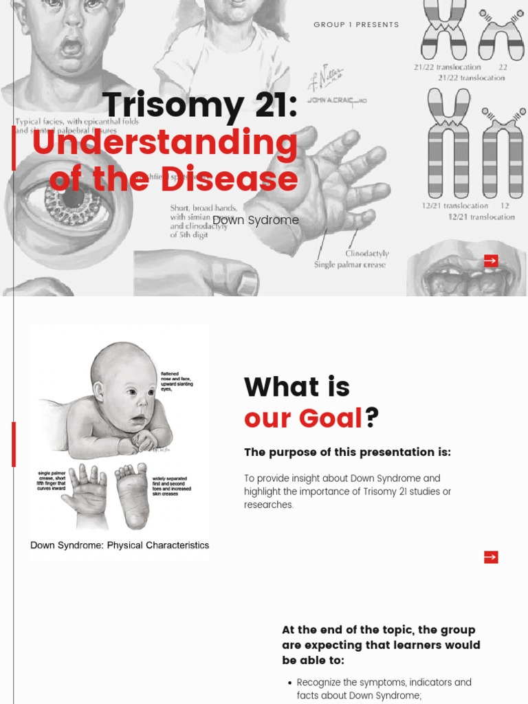 Trisomy 21 An Understanding of The Disease | PDF | Down Syndrome ...