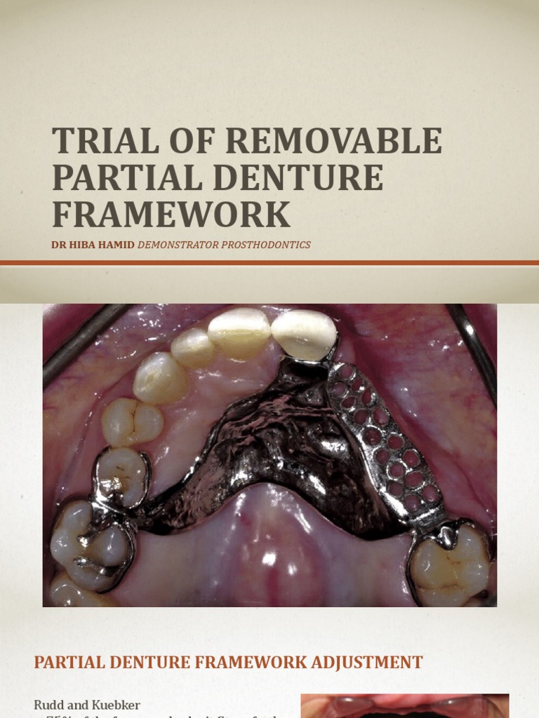 Trial of Removable Partial Denture Framework | PDF