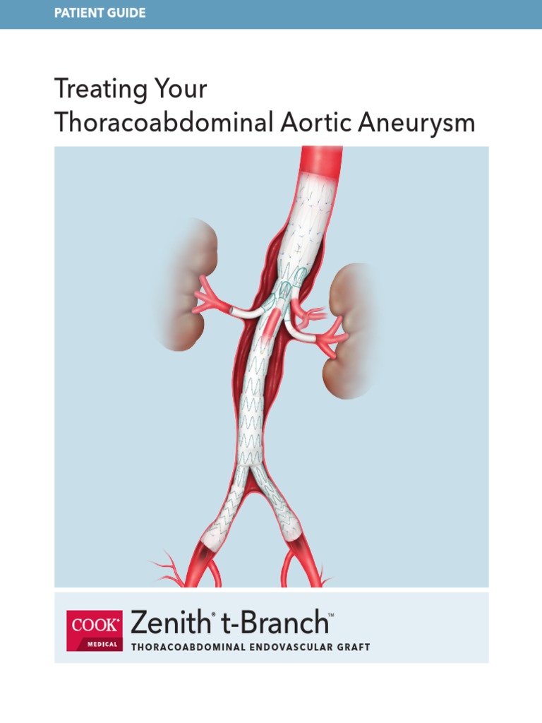 Zenith T-Branch Patient Guide | PDF | Interventional Radiology | Aorta