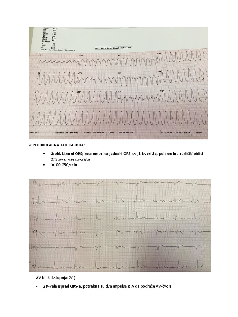 EKG | PDF