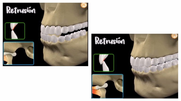 Retrusión Mandibular | PDF