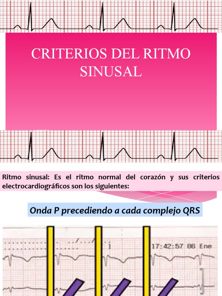 Criterios Del Ritmo Sinusal | PDF