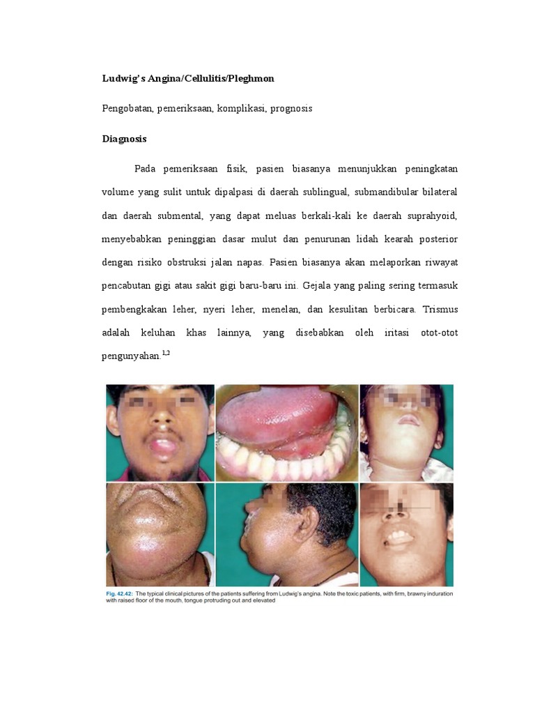 Ludwig's Angina | PDF