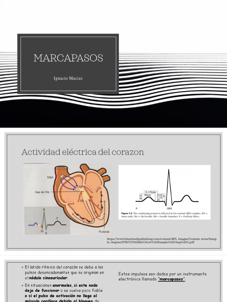 MARCAPASOS | PDF | Marcapasos cardíacos artificiales | Electrocardiografia