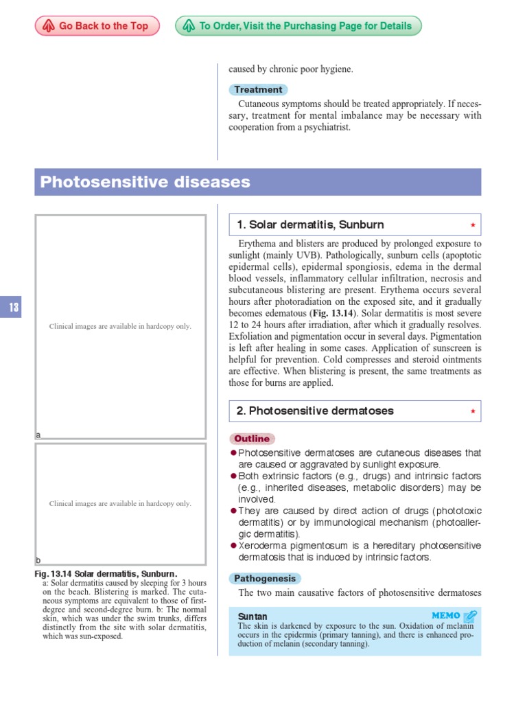 Photosensitive Diseases: 1. Solar Dermatitis, Sunburn | PDF ...