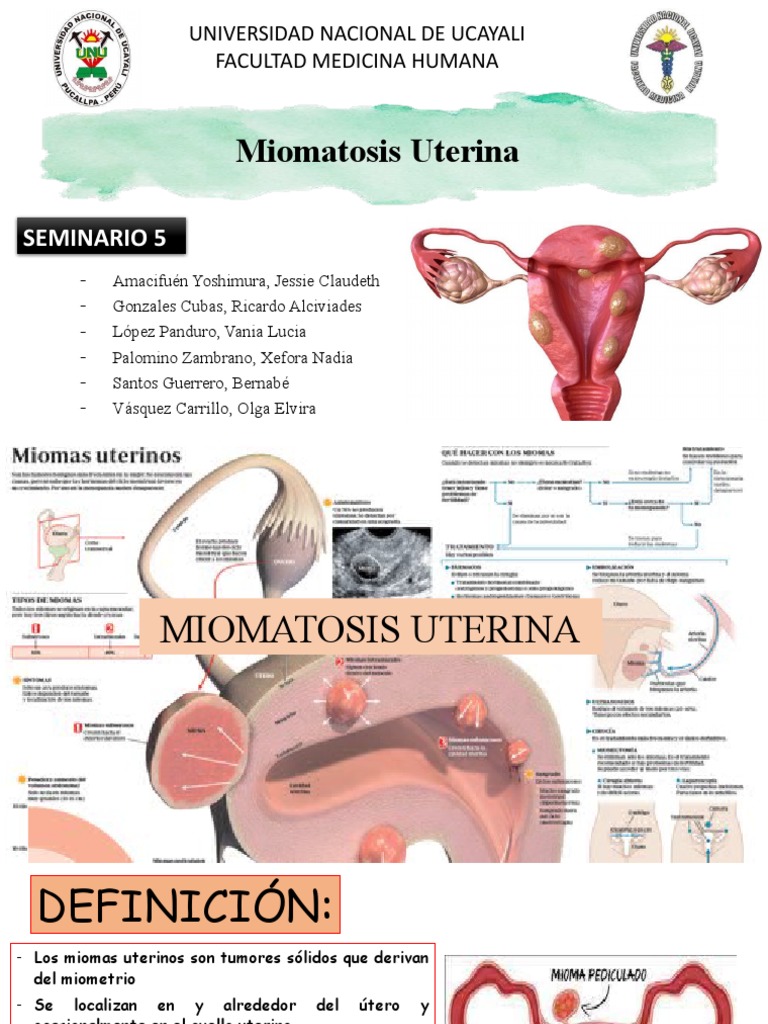 Seminario 5 - Miomatosis Uterina | PDF | El embarazo | Parto