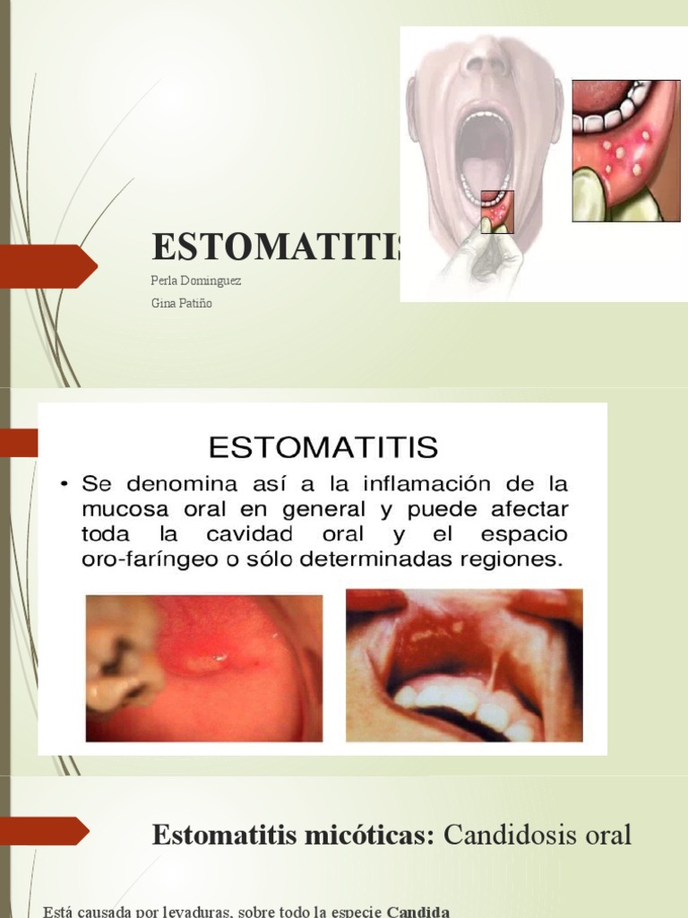 Guía Completa sobre Estomatitis | PDF | Ciencias de la Salud ...