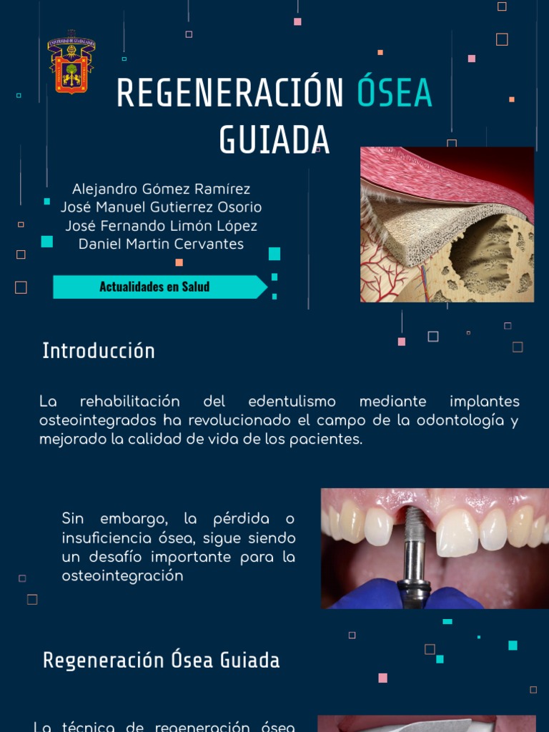 Regeneración Ósea Guiada | PDF | Hueso | Anatomía