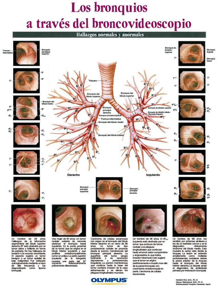The Bronchus Through The Broncoscope - ES | PDF | Sistema respiratorio ...
