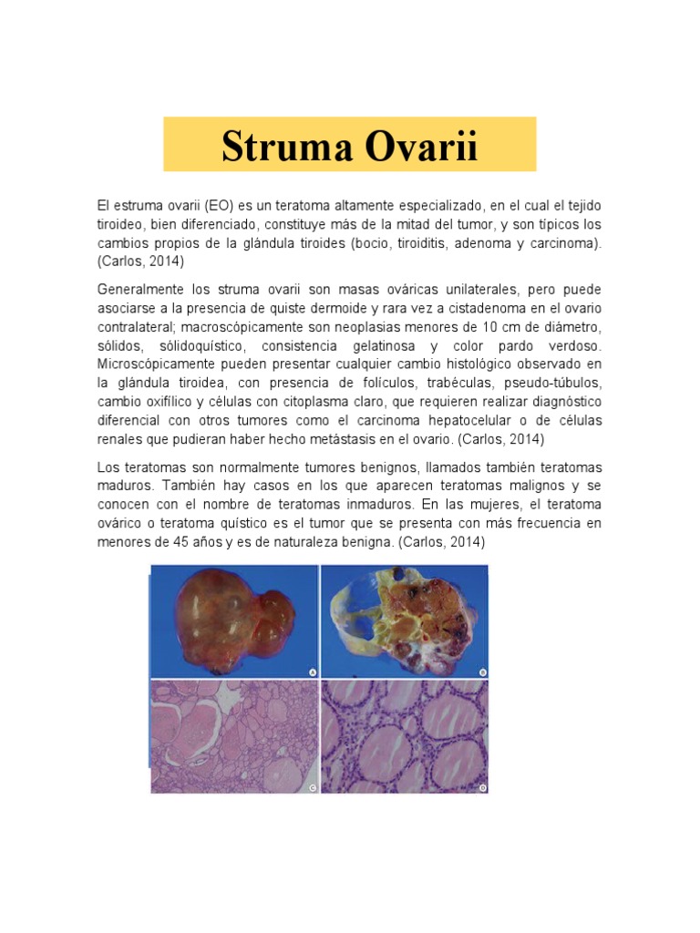 Struma Ovarii | PDF | Neoplasias | Ovario