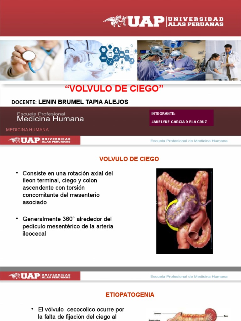 Volvulo de Ciego | PDF | Intestino grueso | Abdomen