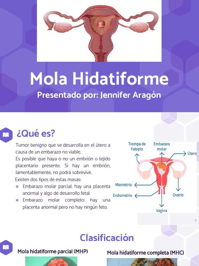 Mola Hidatiforme | PDF | El embarazo | Epidemiología