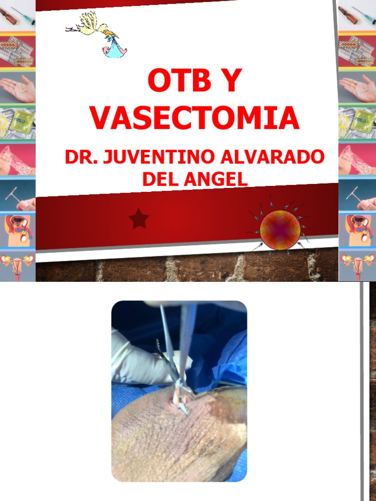 Presentacion Otb y Vasectomia 2022 | PDF | Control de la natalidad | Anatomia sexual