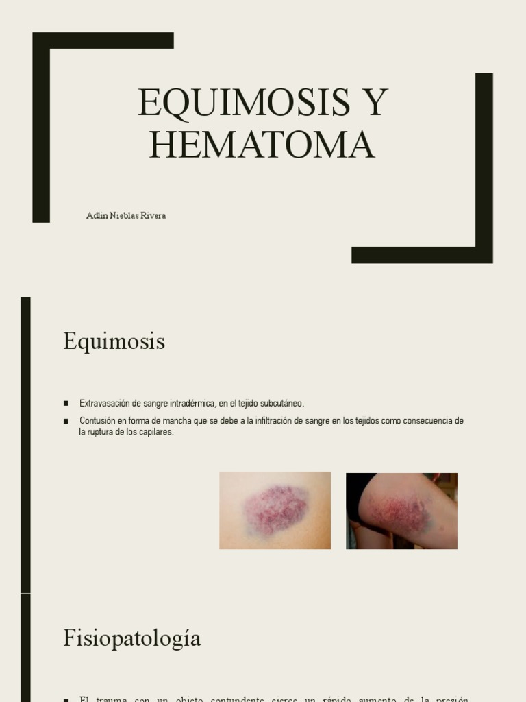 Equimosis y Hematoma | PDF
