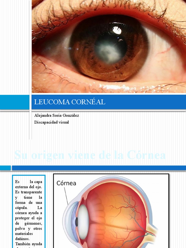 Leucoma Corneal Alejandra Soria | PDF