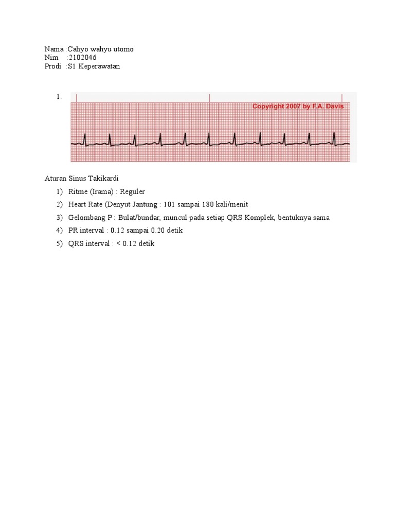 Aturan Sinus Takikardi, EKG Sinus Ritmis, Sinus Bradycardia dan Hipokalemia | PDF