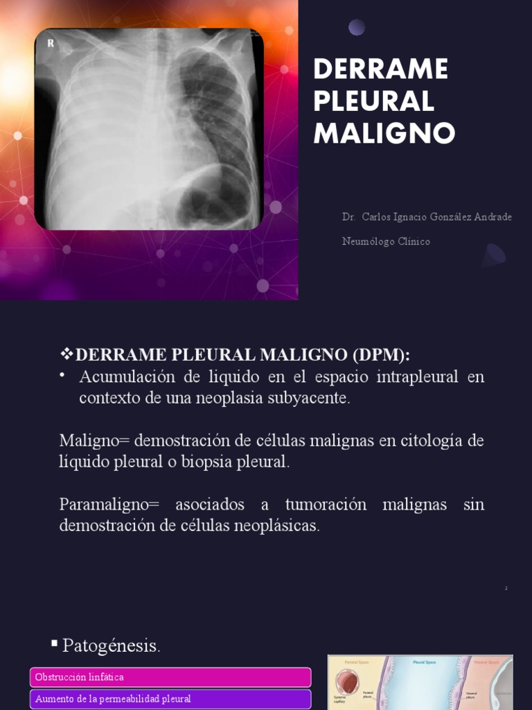 Derrame Pleural Maligno | PDF | Medicina CLINICA | Especialidades Medicas