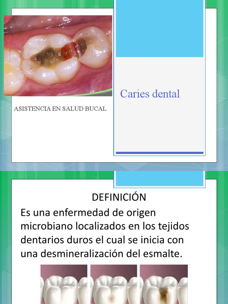 Caries Dental | PDF | Diente | Esmalte de dientes