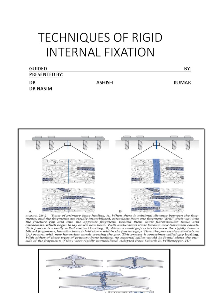 Rigid Internal Fixation | PDF | Screw | Bone