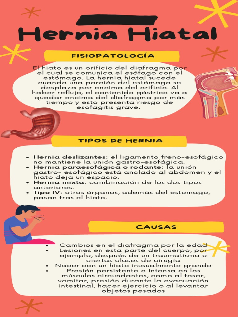 Infografía Sobre Hernia Hiatal | PDF
