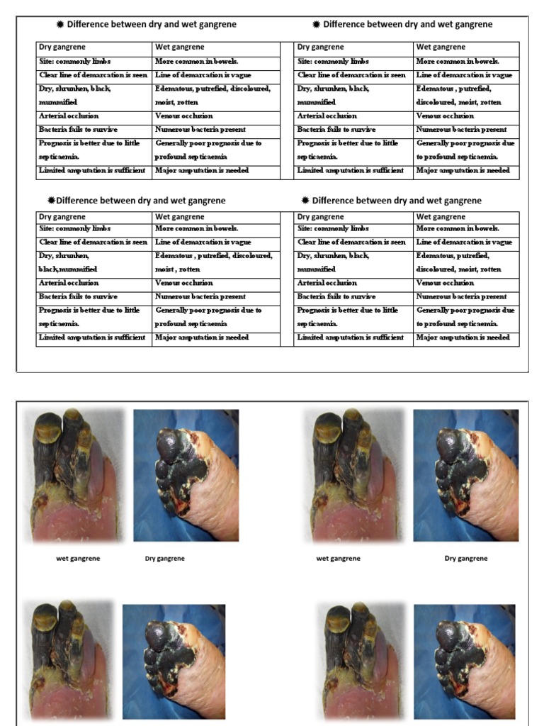 Wet Vs Dry Gangrene Dry Gangrene Occurs When The Blood Supply To
