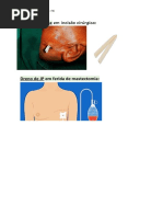 Portovac - Dreno de Sucção | PDF | Especialidades médicas | Medicina ...