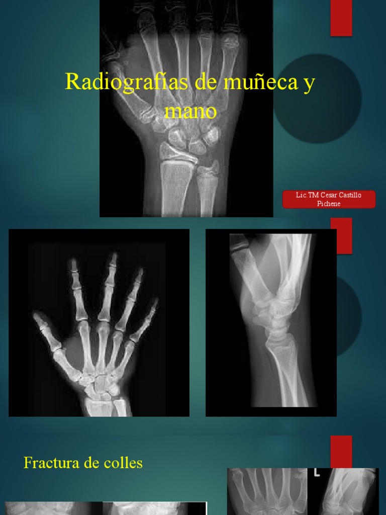 Radiografia de Muñeca y Mano | PDF | Ciencia y matemáticas