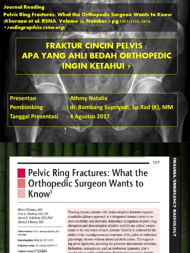 J - Pelvic Ring Fractures - AN Fix | PDF