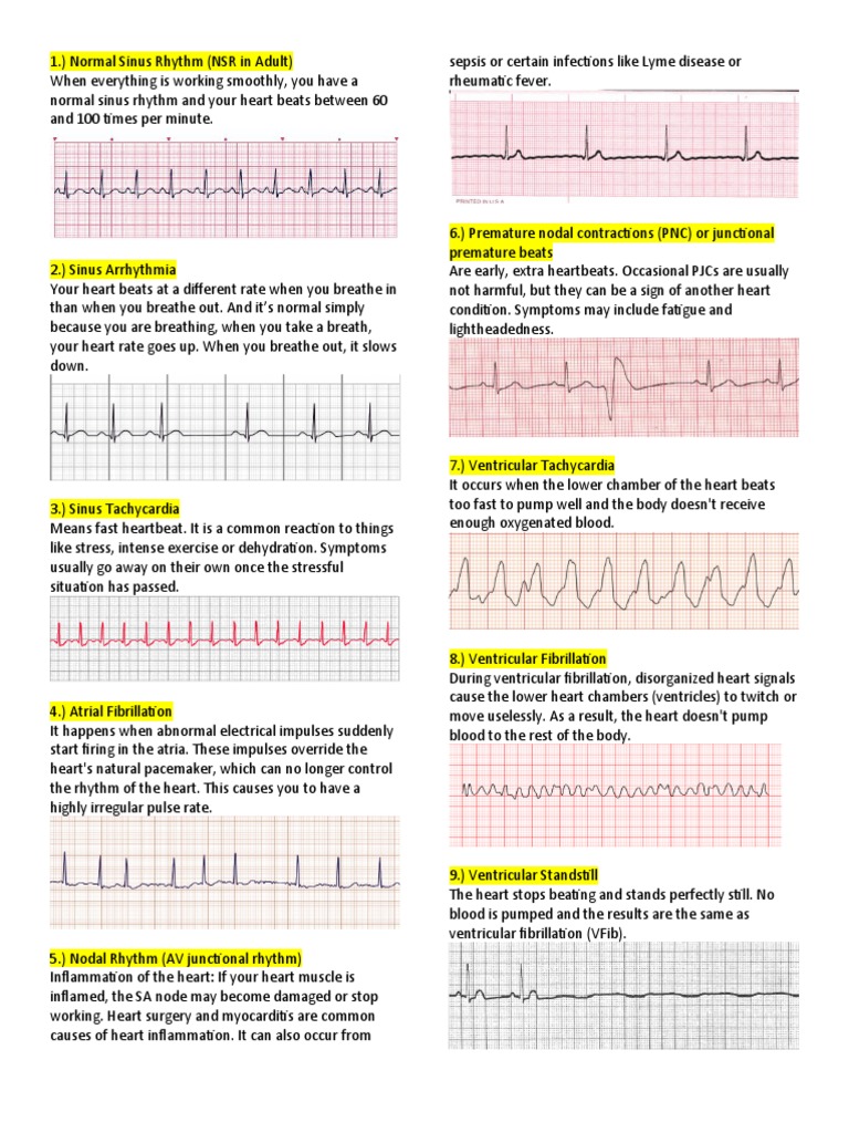 Types of Cardiac Arrhythmias | PDF | Heart | Physiology