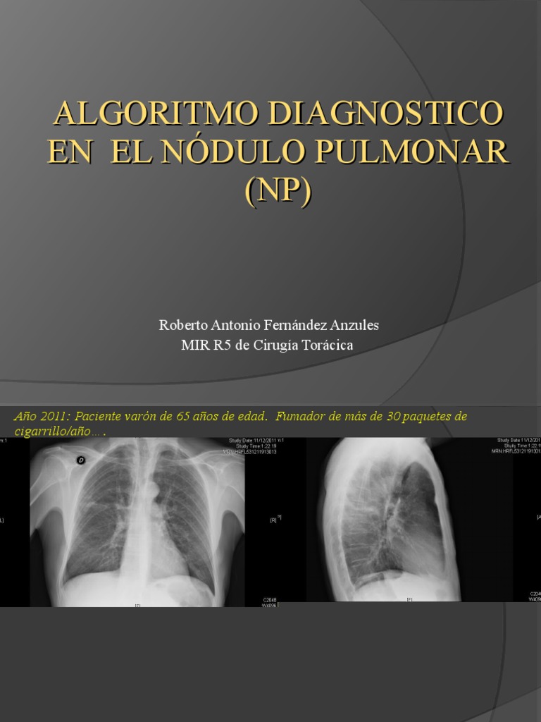 Algoritmo Diagnostico para Nódulo Pulmonar | PDF | Cáncer de pulmón | Cáncer
