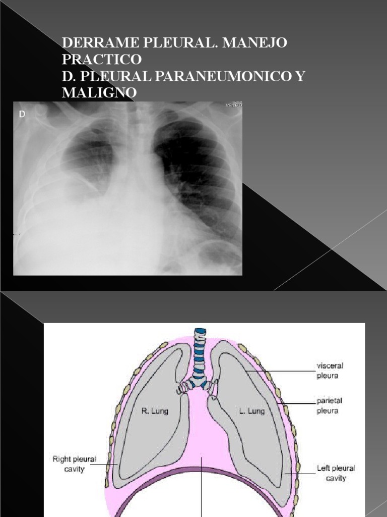 Manejo del Derrame Pleural Maligno | PDF | Enfermedades y trastornos ...