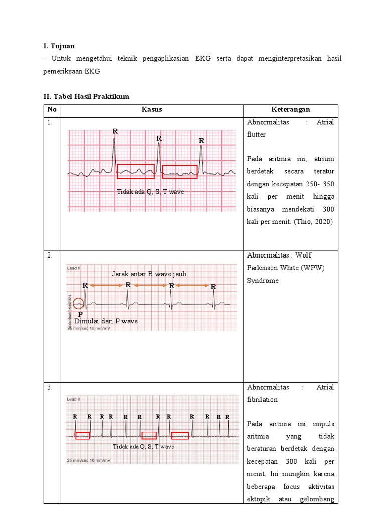 ANALISIS HASIL PEMERIKSAAN EKG DALAM MENDETEKSI ABNORMALITAS JANTUNG | PDF
