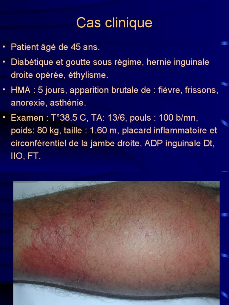 ERYSIPELE | PDF | Spécialités médicales | Épidémiologie