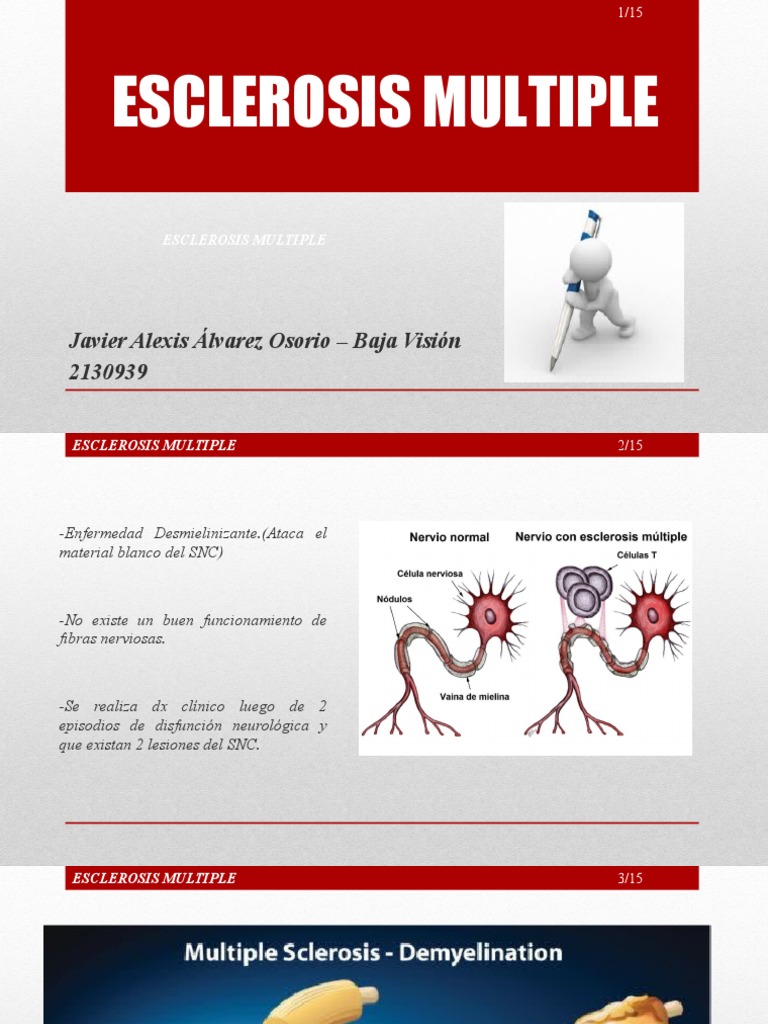 Esclerosis Multiple | PDF Esclerosis Multiple | PDF